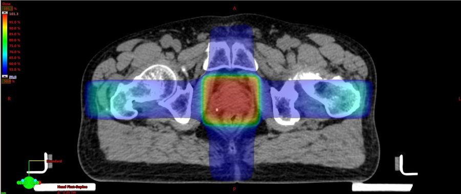IMRT：強度変調放射線治療 | 関西放射線治療センター | 彩都友紘会病院